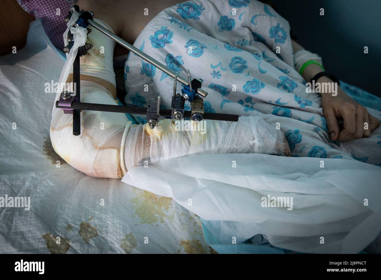 A view of Ukrainian solider Mikhai's injury on his right hand, which he ...