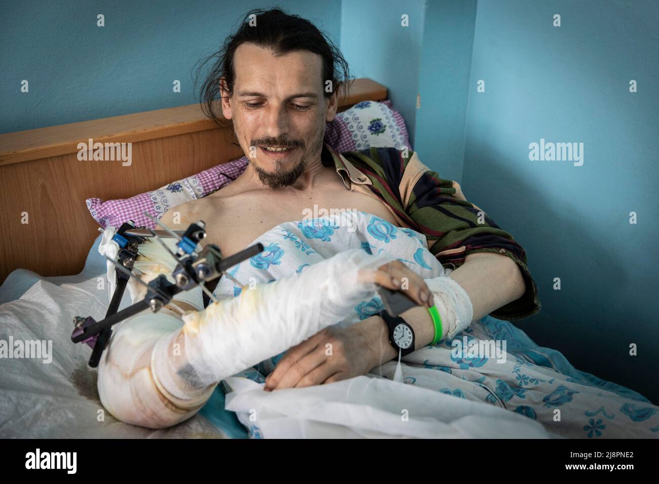 Ukrainian soldier Mikhail shows his injury of a bone fracture on his ...