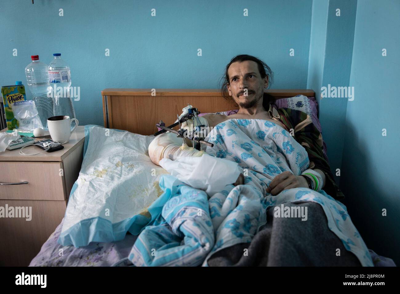 Displaced fracture hi-res stock photography and images - Alamy
