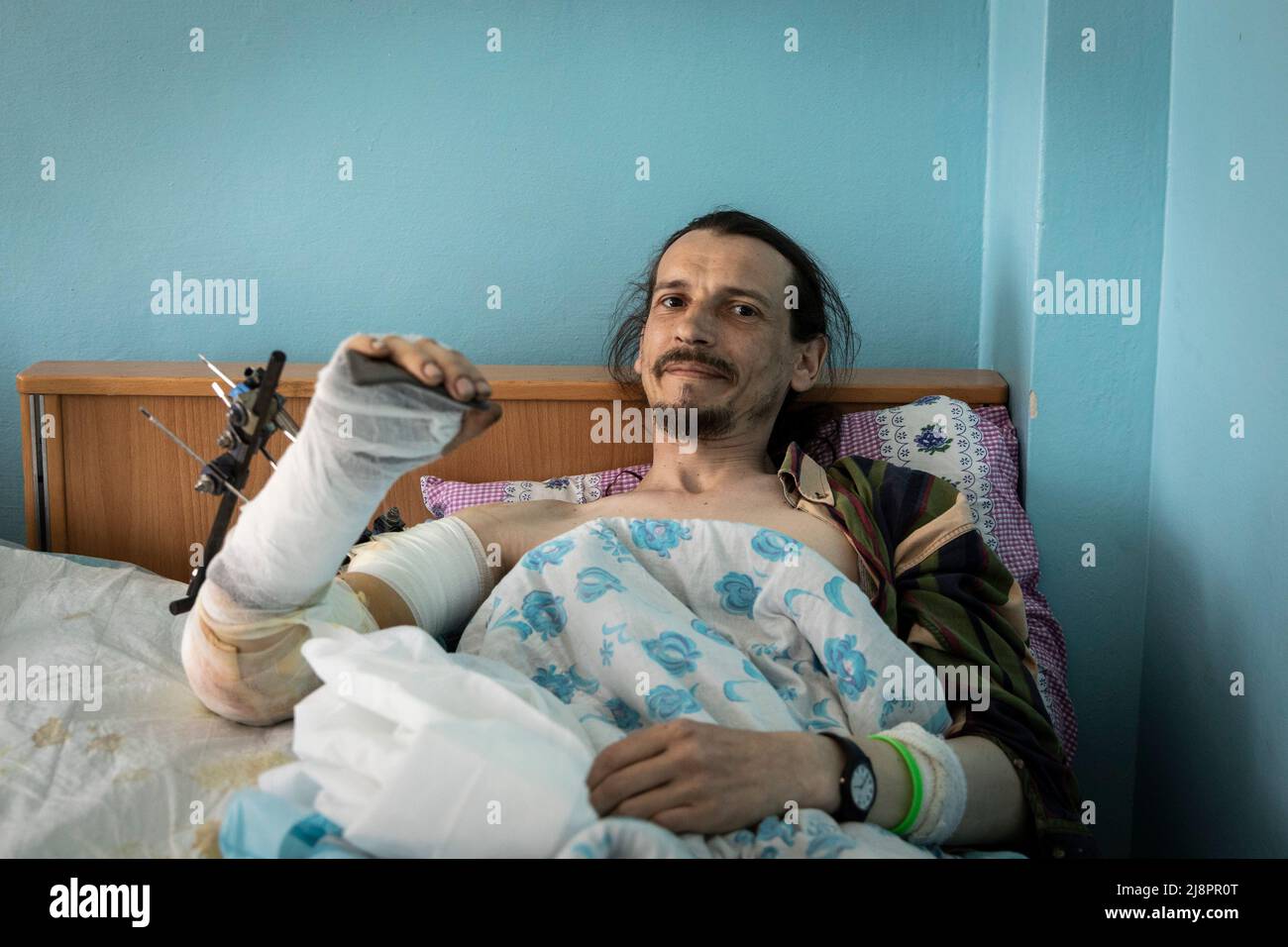 Displaced fracture hi-res stock photography and images - Alamy