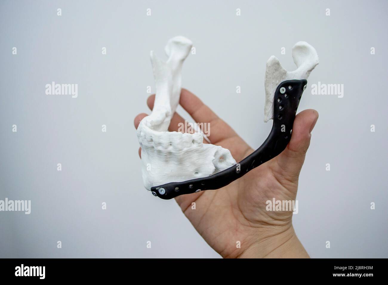 Man holding implantation of endoprosthesis of lower jaw Stock Photo - Alamy
