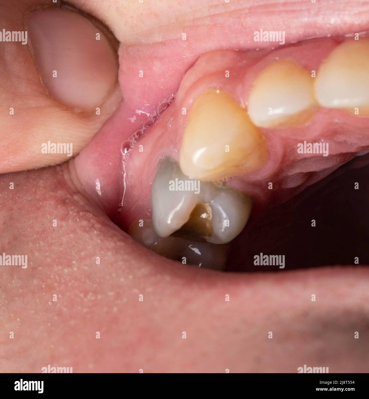 Secondary caries hi-res stock photography and images - Alamy