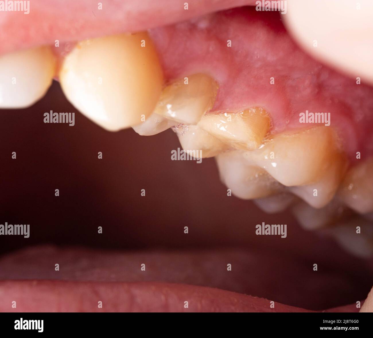 Dissection of decayed teeth for the installation of a dental crown in ...