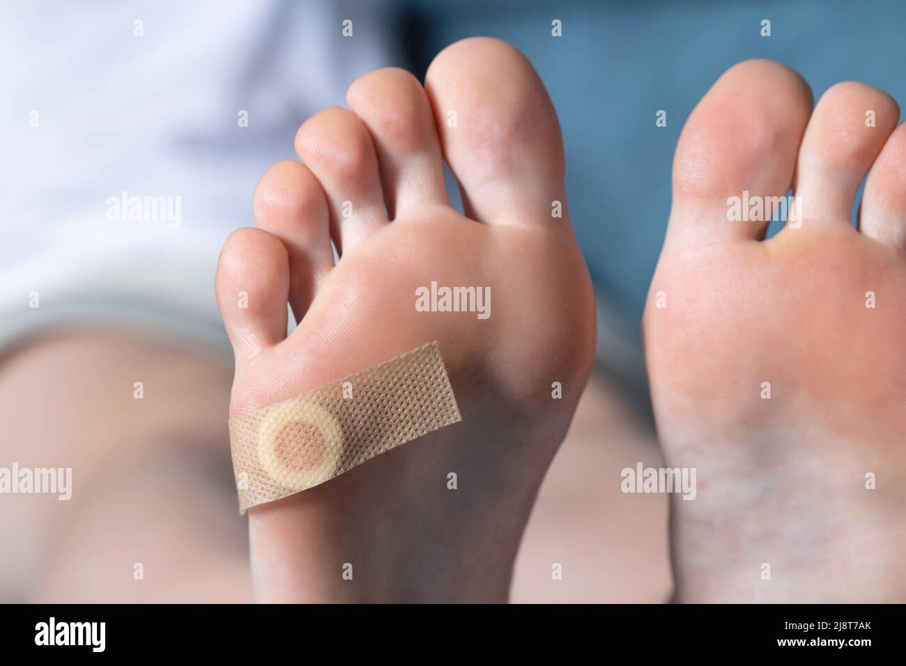 Woman's foot with glued medical plaster for plantar wart. Treatment of ...