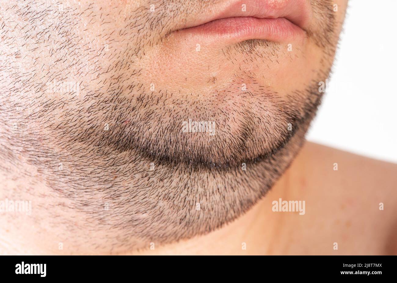 The face of an overweight man. Fat double chin. aesthetic defect ...