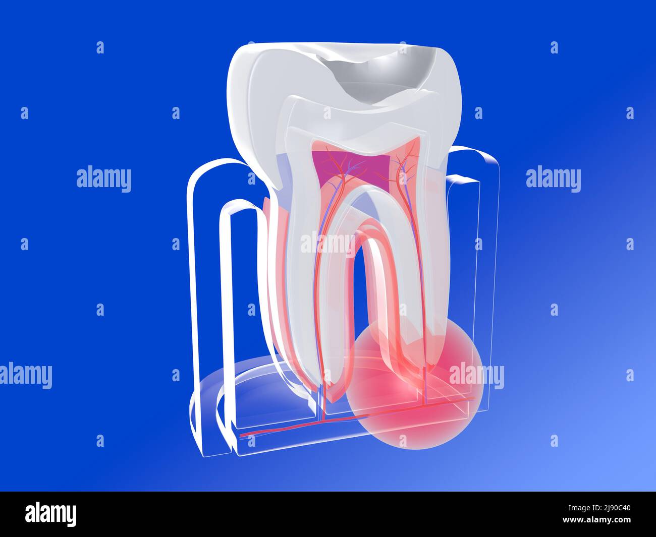 3d illustration of a transparent tooth with caries and infection. Put ...
