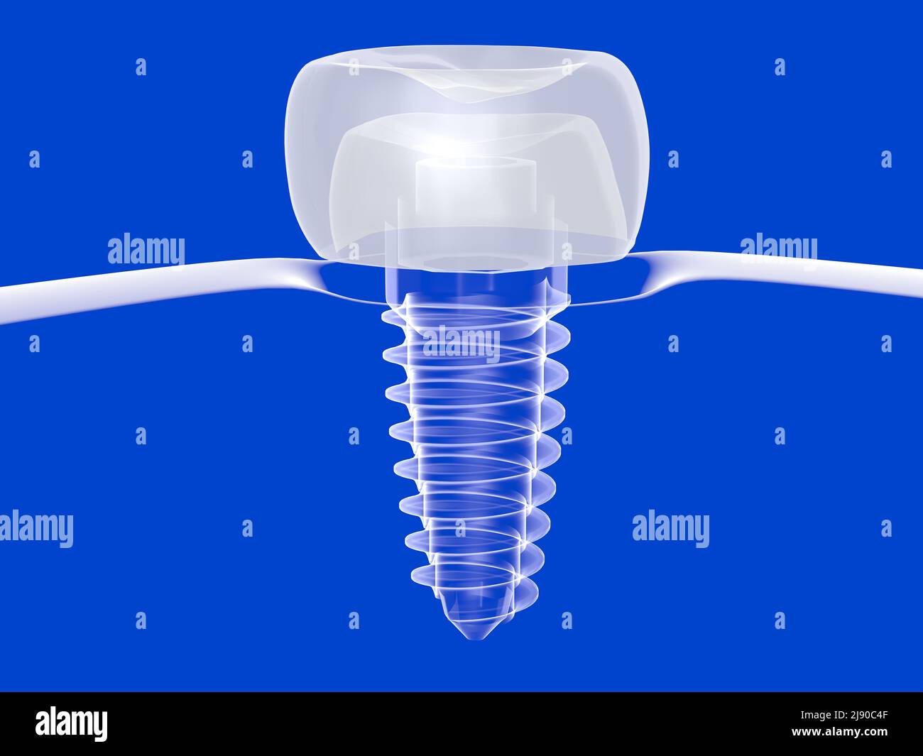 3d illustration of a dental implant in transparent graphic style. Put ...