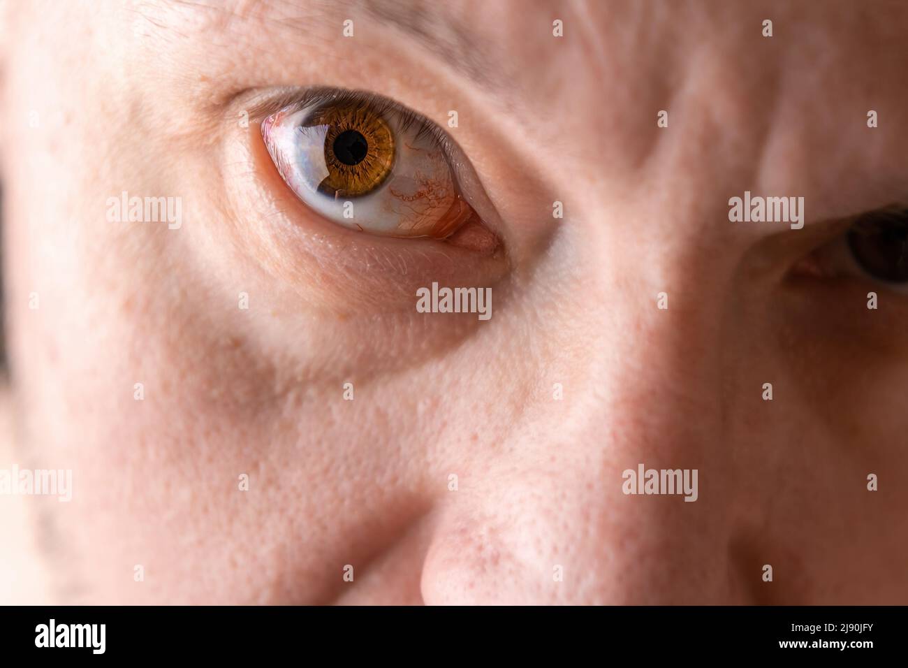 Subconjunctival hemorrhage - hyposphagma. Close up of man's face ...