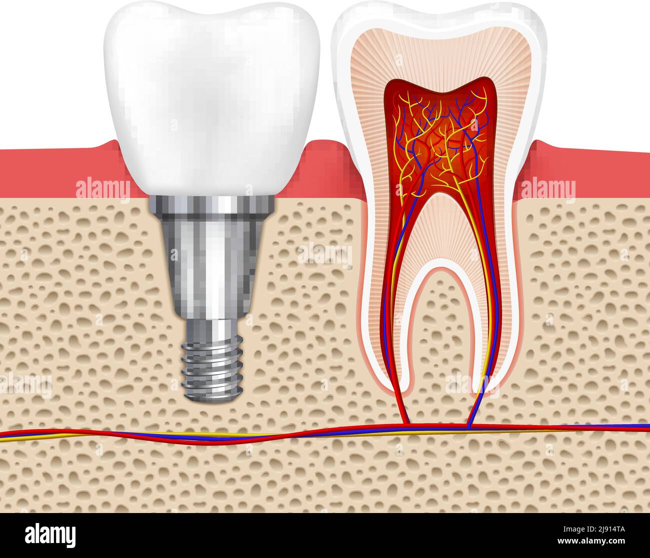 Healthy teeth and dental implant. Implant tooth, health tooth medical ...