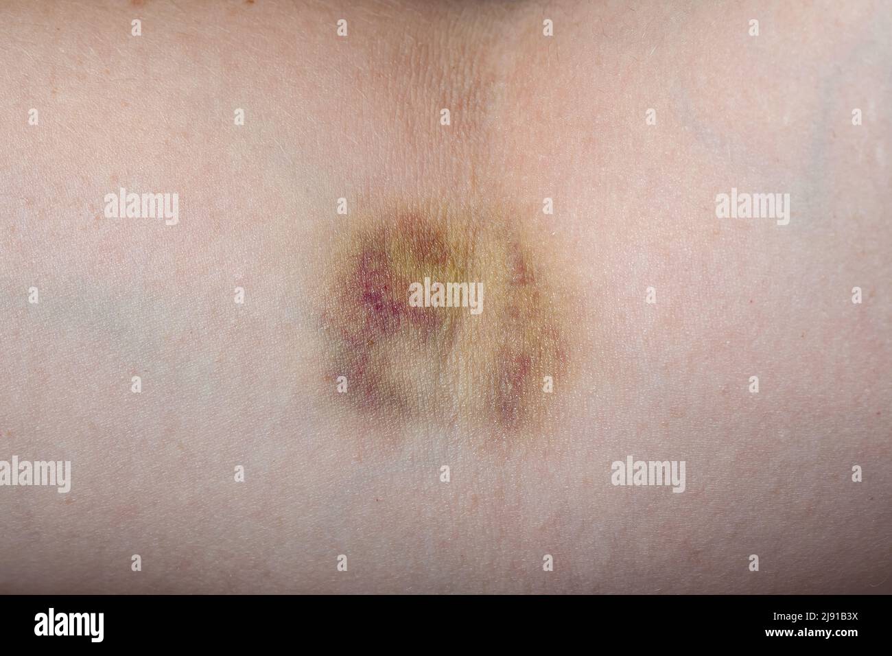 Vein bruise hi-res stock photography and images - Alamy