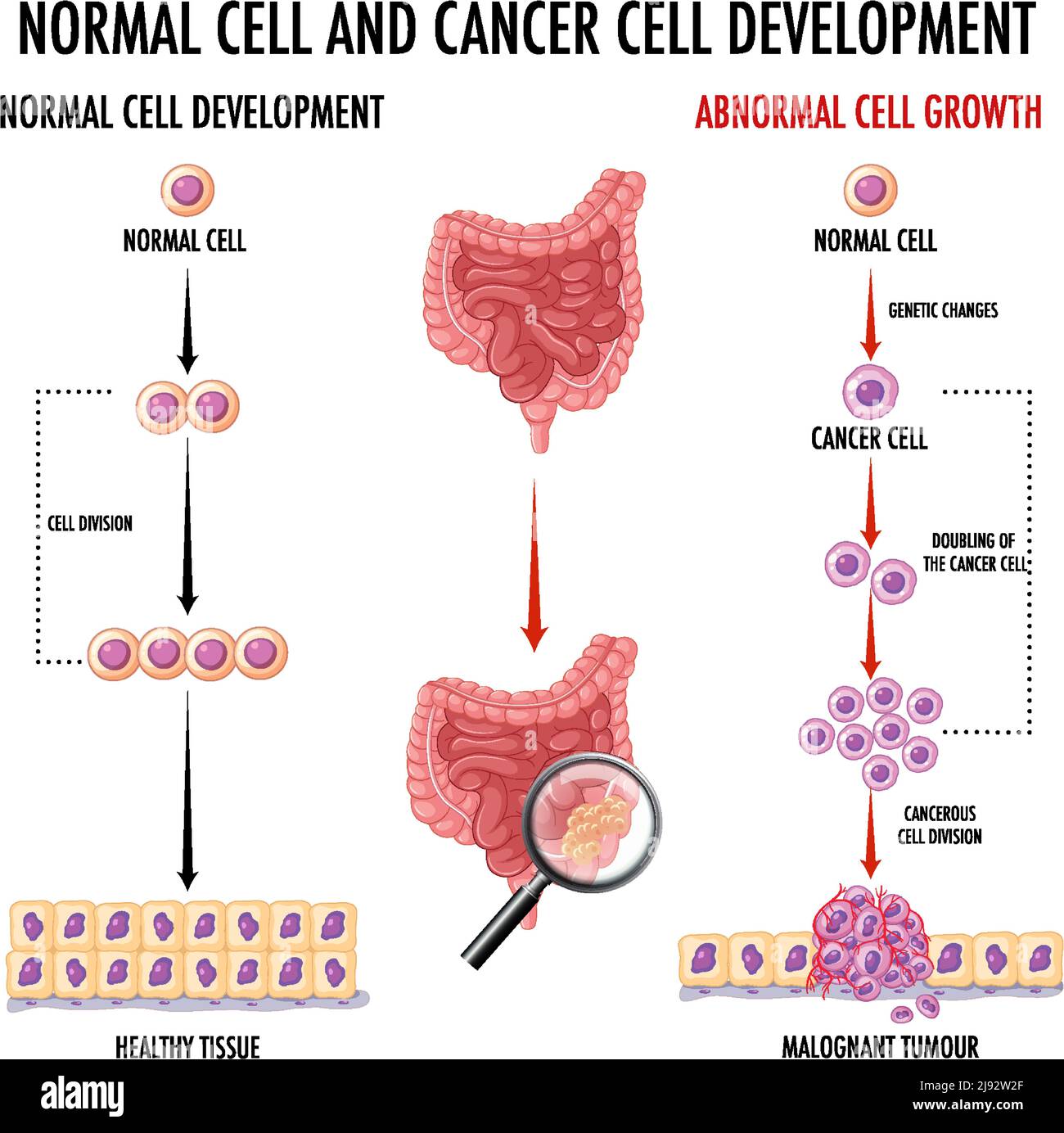 Diagram showing normal and cancer cells in human illustration Stock ...