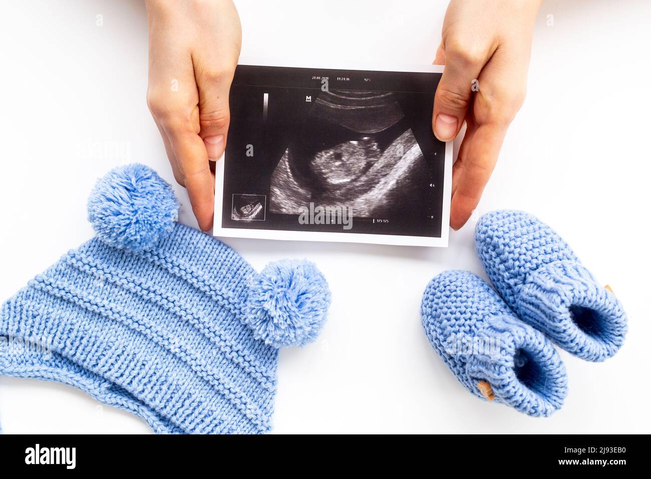 Pregnancy background. Baby accessories with ultrasound picture of ...