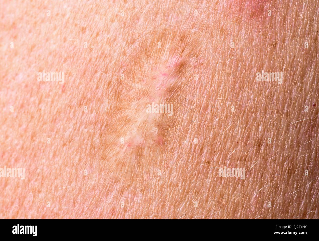 Smallpox vaccination hi-res stock photography and images - Alamy