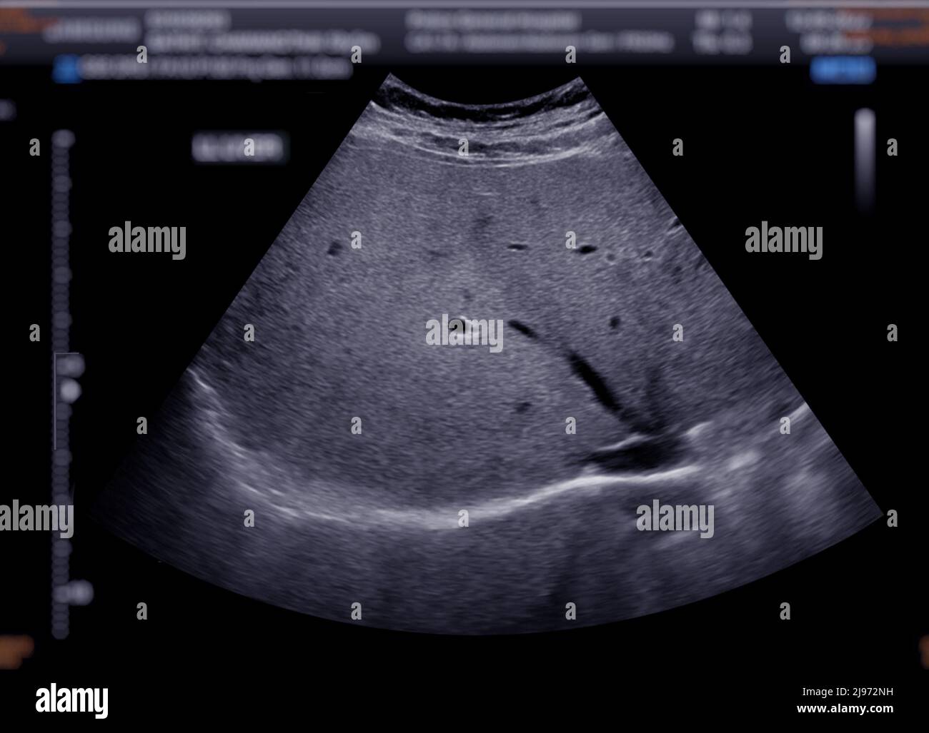 Ultrasound upper abdomen showing liver Stock Photo - Alamy