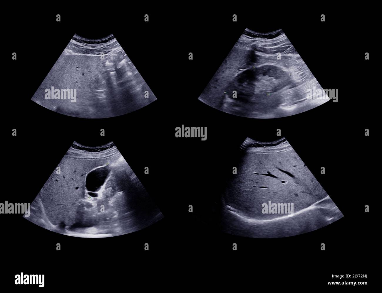 Ultrasound upper abdomen showing liver , gallbladder and kidney Stock ...