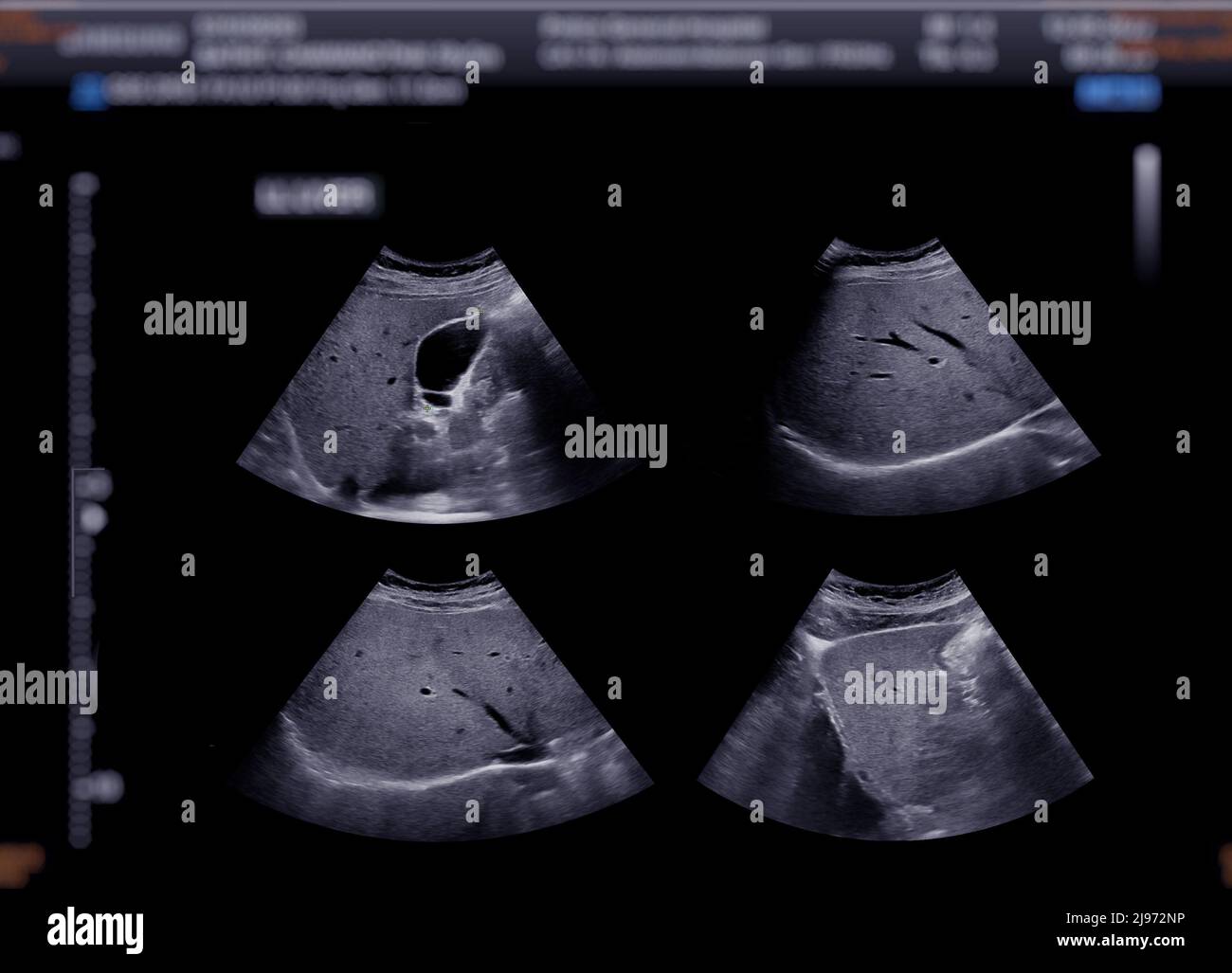 Ultrasound upper abdomen showing gallbladder for diagnosis gallbladder ...