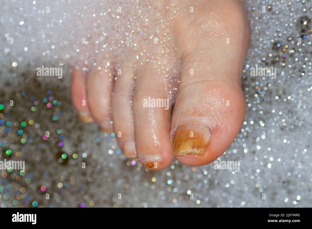 Malum perforans hi-res stock photography and images - Alamy