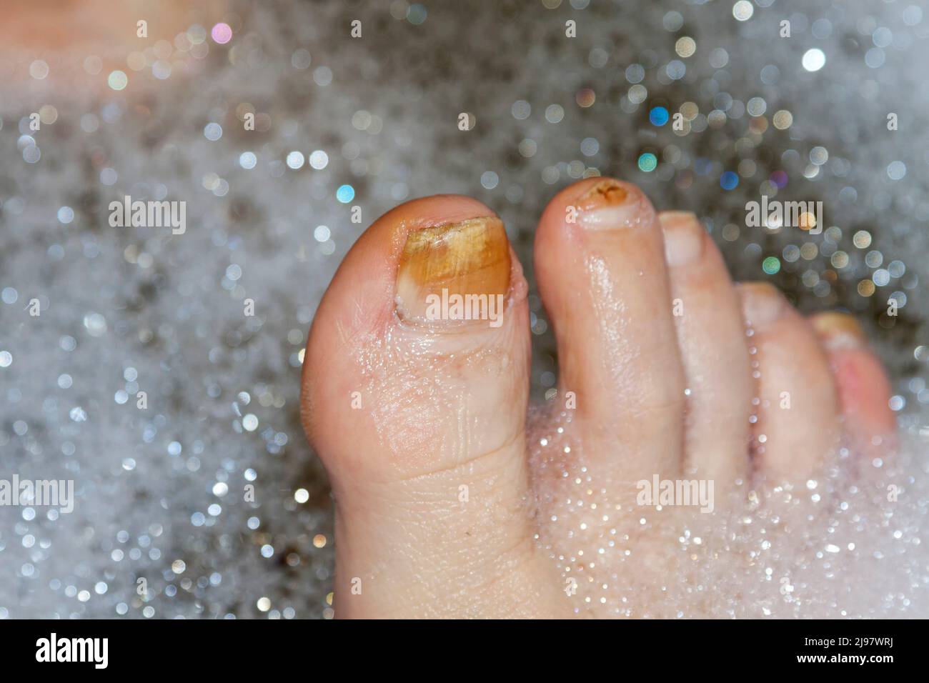 Toe infection hi-res stock photography and images - Alamy