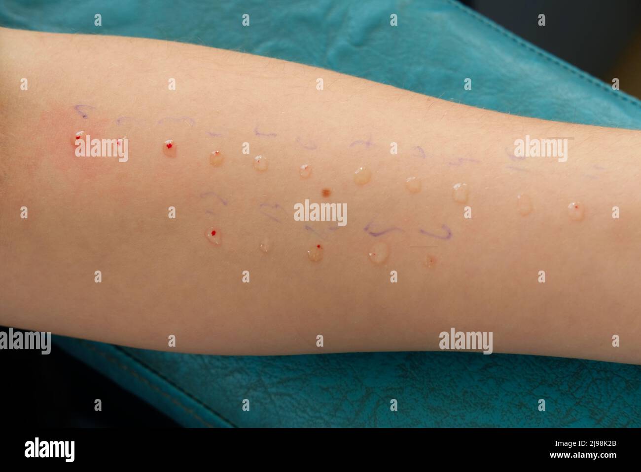 close up of child forearm tested for allergy Stock Photo - Alamy