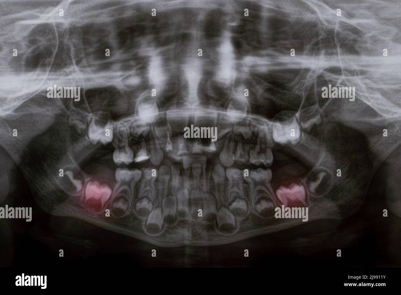 A panoramic X-ray shows several embedded and impacted teeth on both the ...