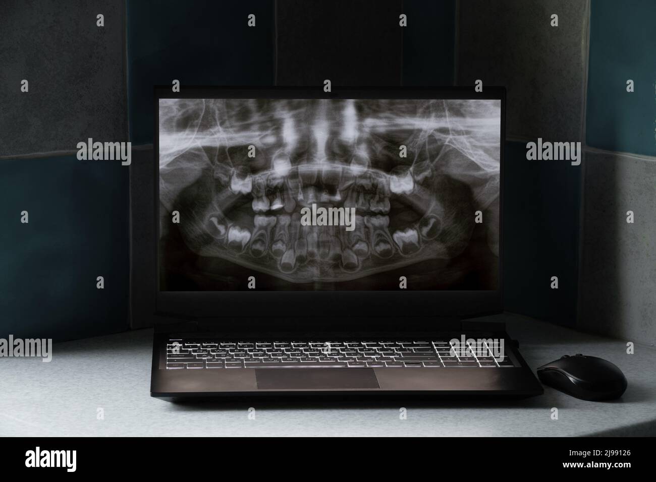 panoramic X-ray of children's teeth of two jaws, orthopantomogram of ...