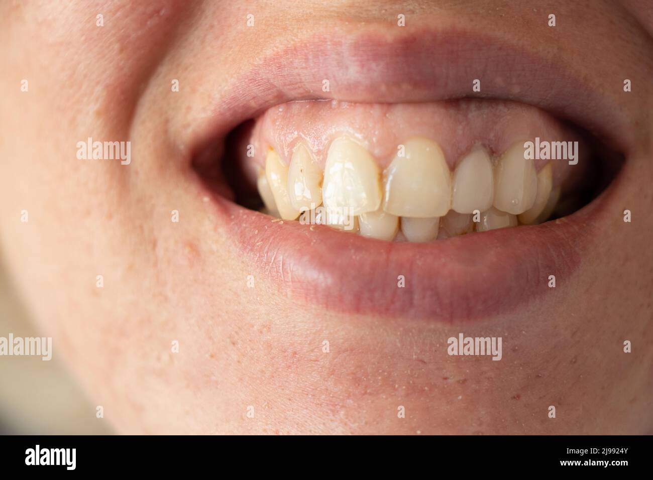Yellowest Teeth In The World