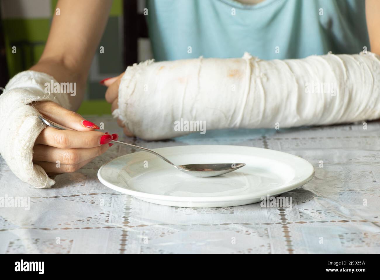 Arm fractures hi-res stock photography and images - Alamy