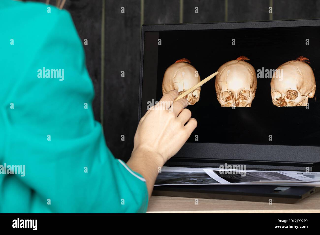 3D computed tomography of the brain with a fracture of the frontal part ...