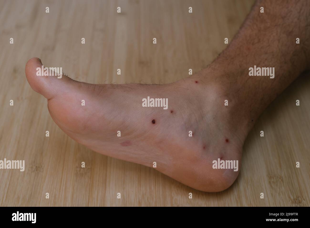 Pustules acne hi-res stock photography and images - Alamy