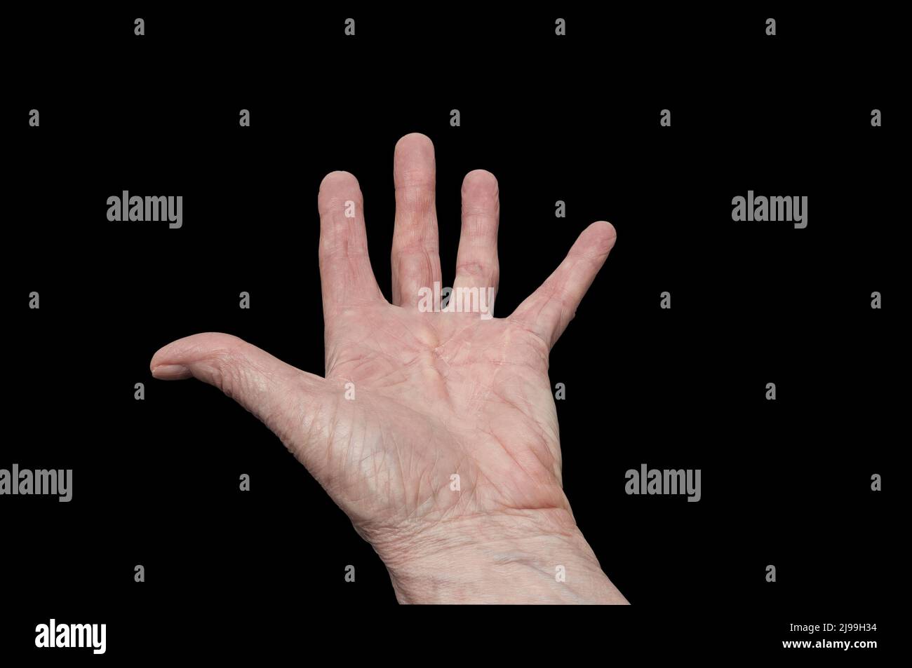 Dupuytren's Contracture, Left Hand On Black Background Stock Photo - Alamy