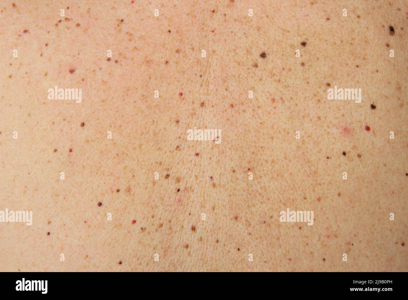 Moles and birthmark on human skin texture. photo horizontal full frame ...