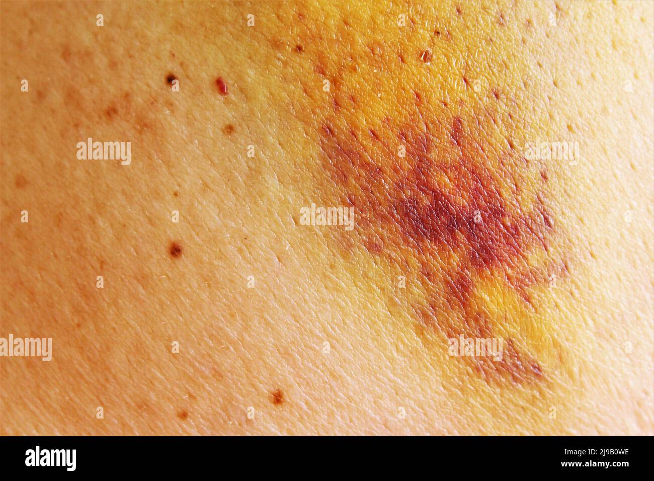 Skin bruise texture hi-res stock photography and images - Alamy