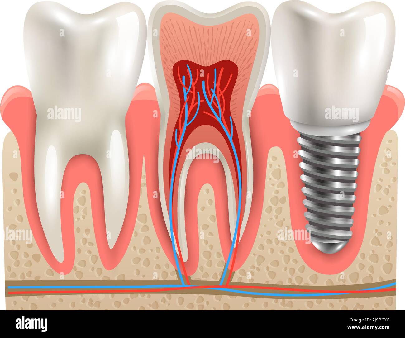 Dental implant and real tooth anatomy closeup cut away section model ...