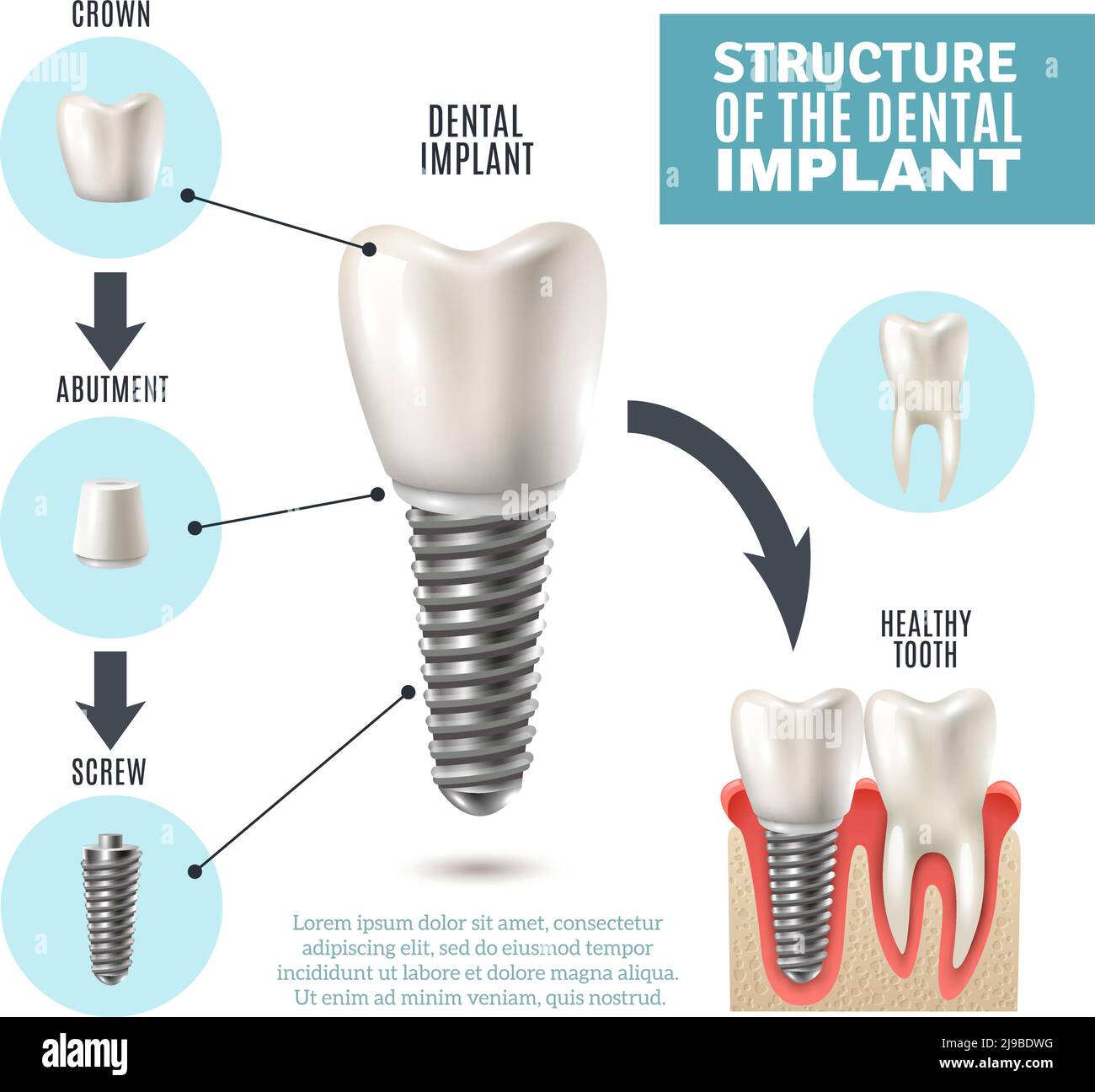 Dental implant structure medical pictorial educative infographic poster ...