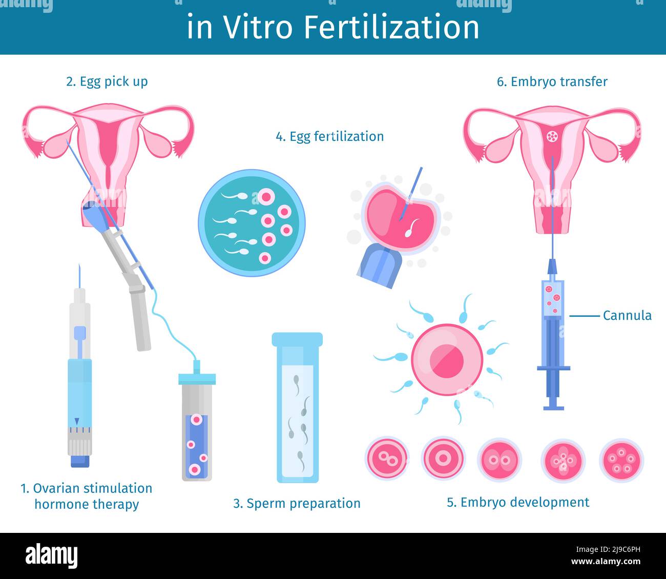 In vitro fertilization process concept with steps of insemination procedure in flat style ...