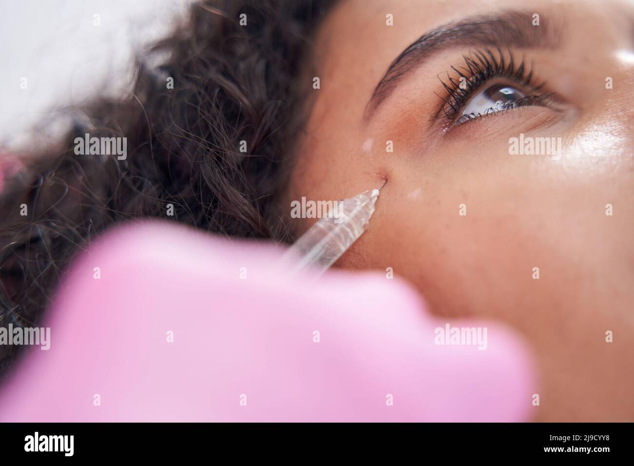 Syringe needle penetrates under the skin under the eye along pre-marked ...