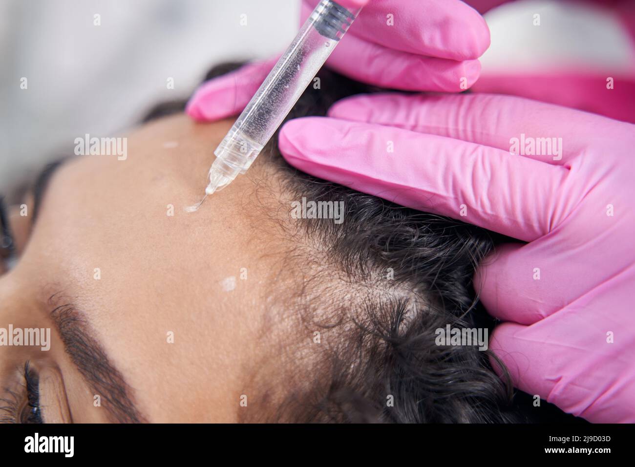 Syringe is injected subcutaneously on the forehead along pre-drawn ...