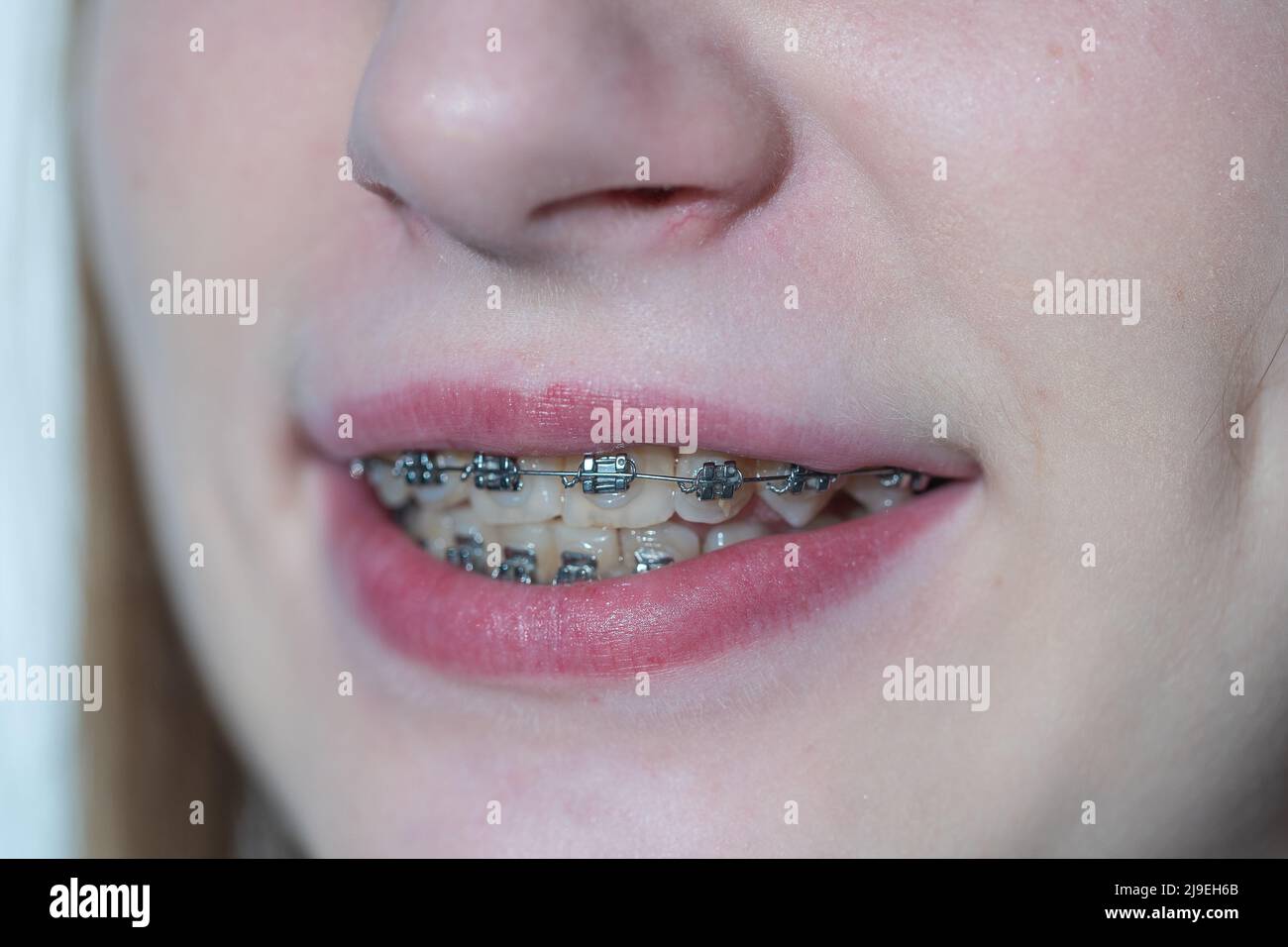 Cute young girl with dental braces. Girl teenager smiling close up ...