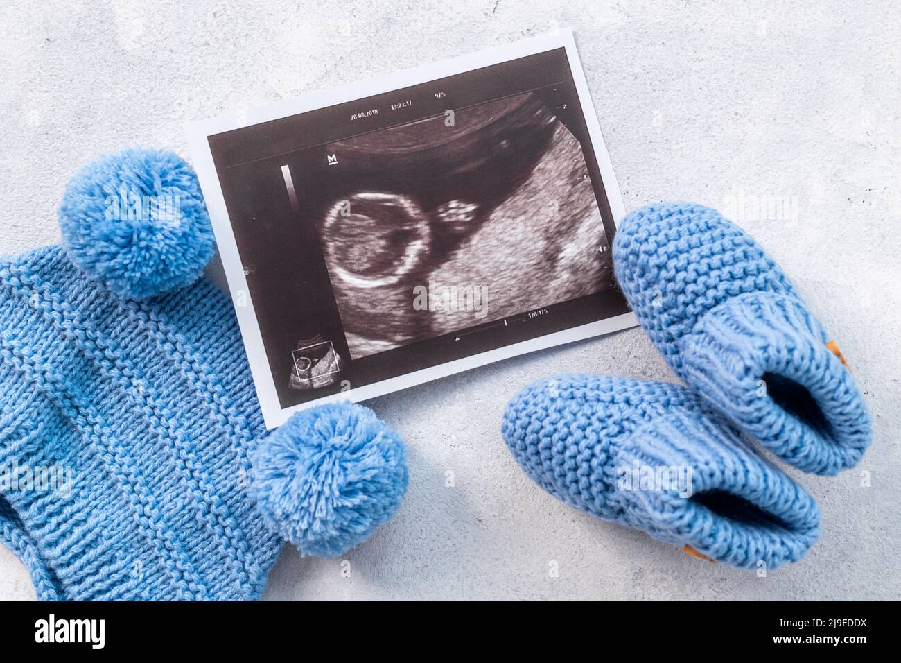 Pregnancy background. Baby accessories with ultrasound picture of ...