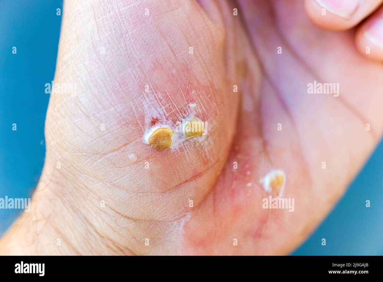 Cut wounds on one hand, bleeding, with white bubbles from the hydrogen ...