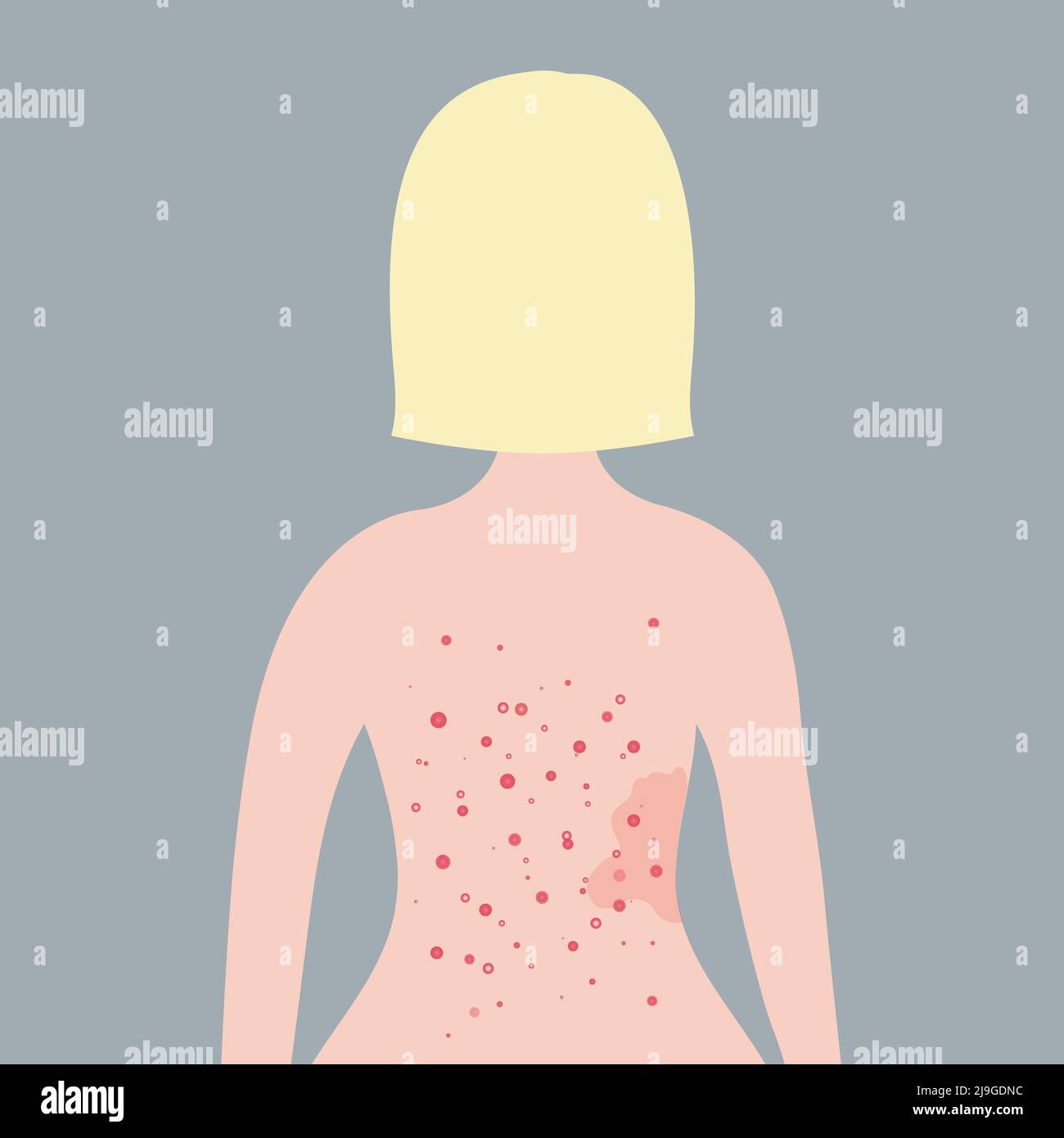 Caucasian short blonde hair woman with acne on her back. Skin problems ...