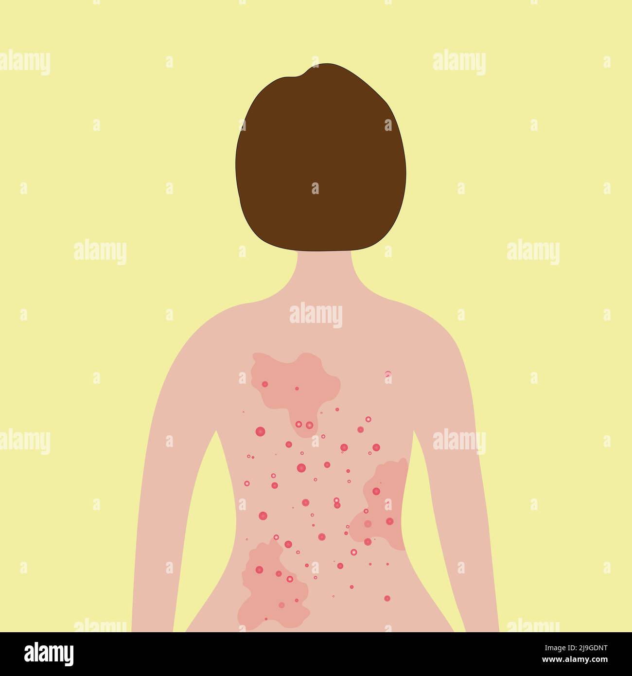 Acne on female back. Allergy treatment, skin problems concept Stock ...