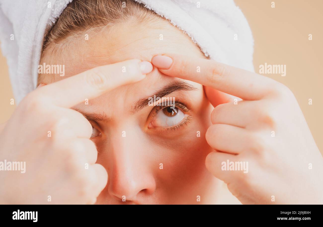 Close up squeezing pimples on her face. Acne blemish spots skin on ...