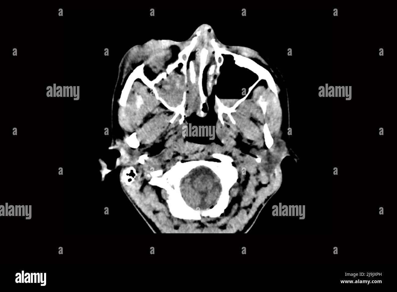 computed tomography of the brain with a fracture of the frontal part of ...