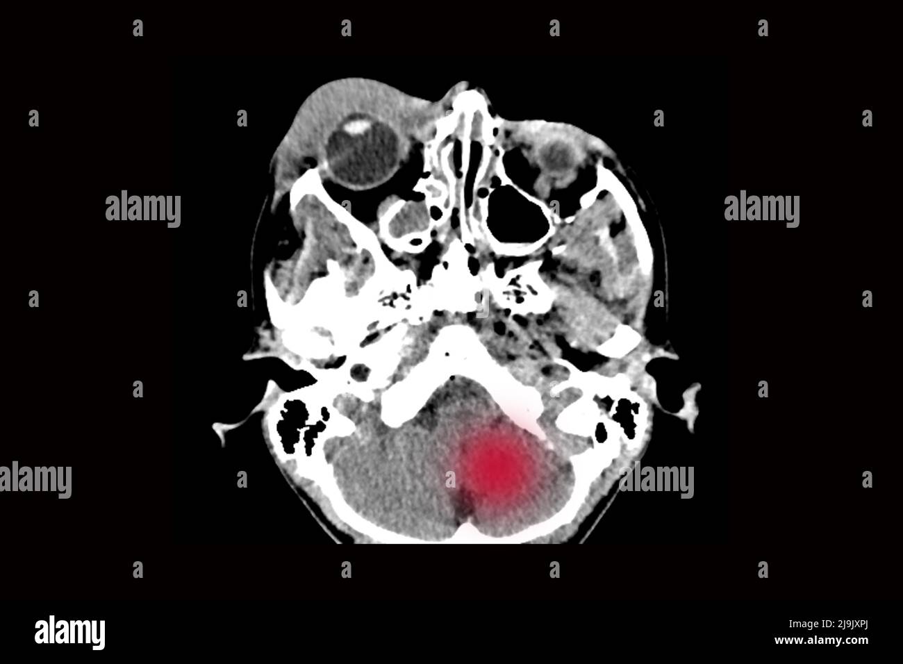 computed tomography of the brain with a fracture of the frontal part of ...