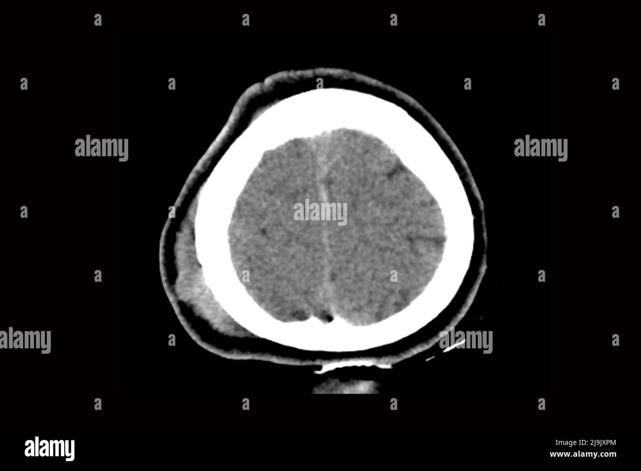 computed tomography of the brain with a fracture of the frontal part of ...