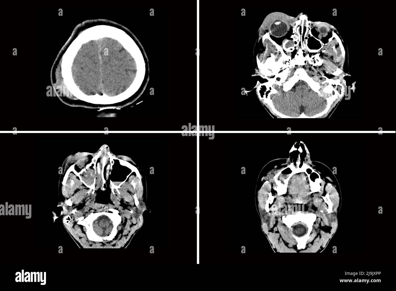 computed tomography of the brain with a fracture of the frontal part of ...