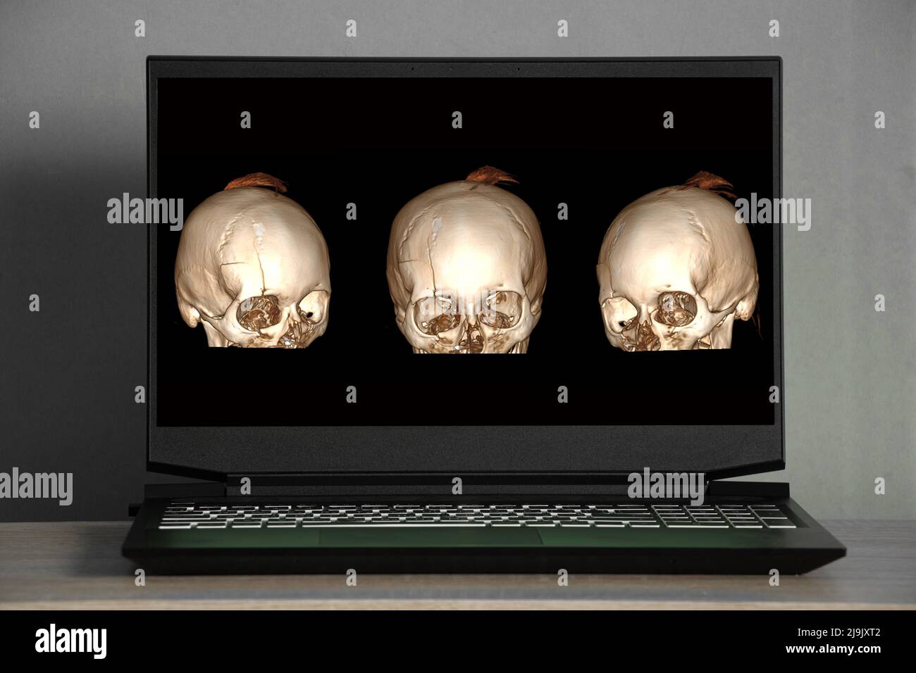 3d computed tomography of the brain with a fracture of the frontal part ...