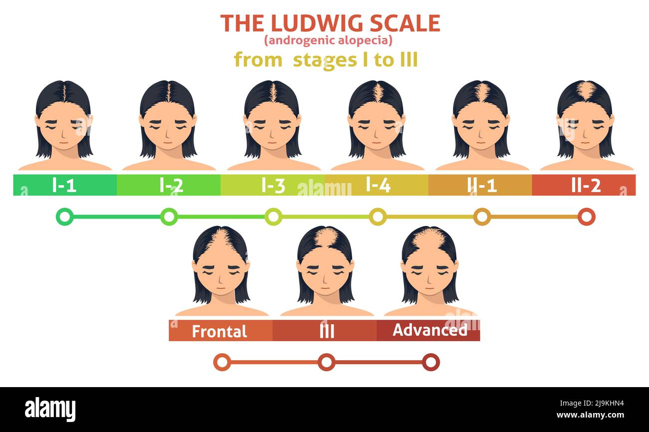 Female Androgenetic Alopecia Cut Out Stock Images And Pictures Alamy