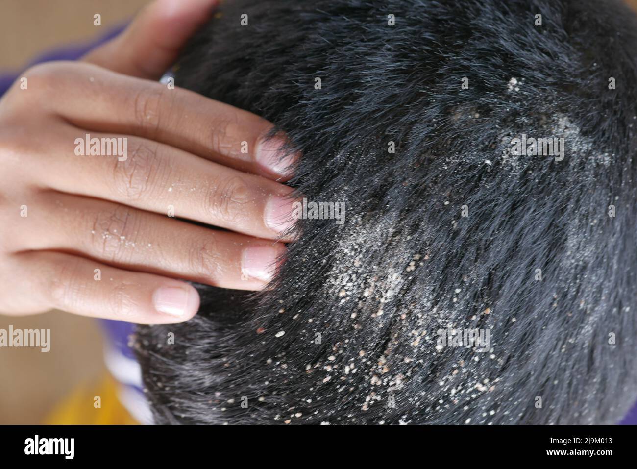 men with dandruff in his hair, closeup Stock Photo - Alamy